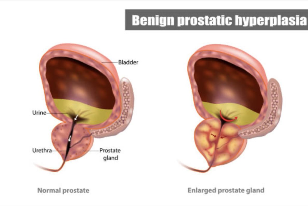 BPH – Southern Westchester Urology