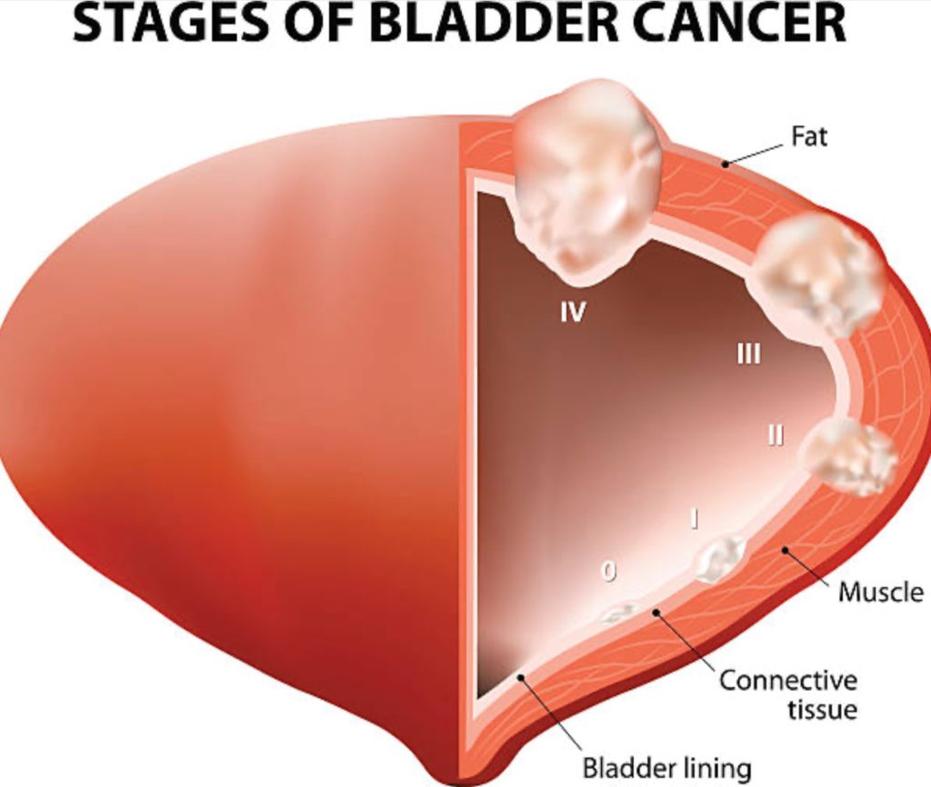 Bladder Cancer - Southern Westchester Urology