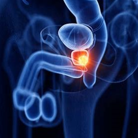 Prostate Cancer - Southern Westchester Urology